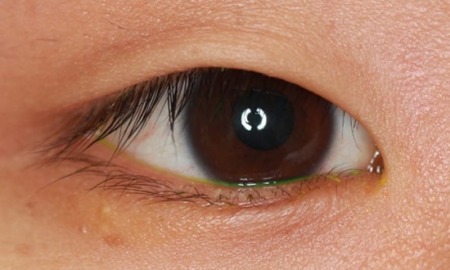 睫毛内反/眼瞼内反｜文京区の東京眼科形成外科クリニック